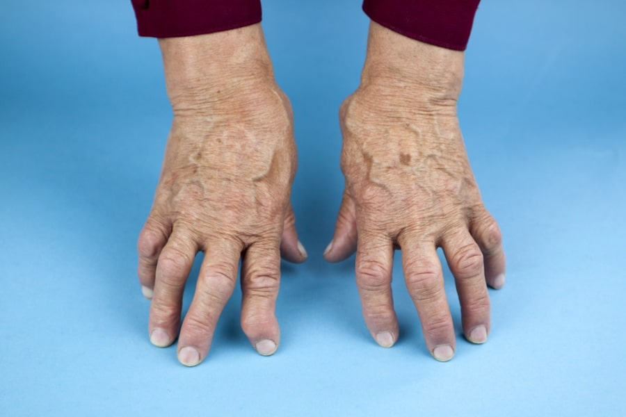 Rheumatoid Arthritis - Here are Five Early Warning Signs – Flexcin ...